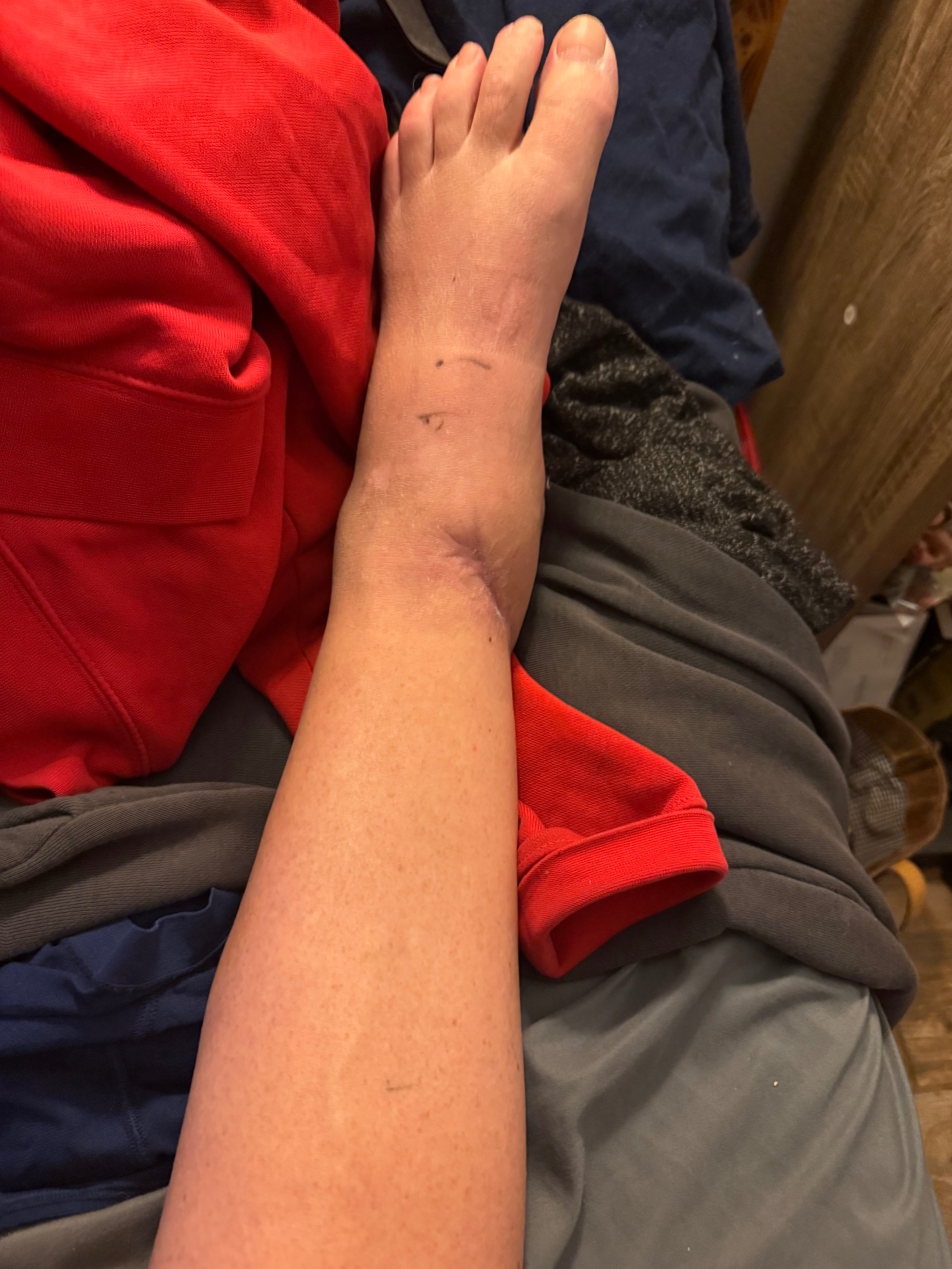 Fundraiser by Rebecca Potts : Help Save My Ankle and Support My Family